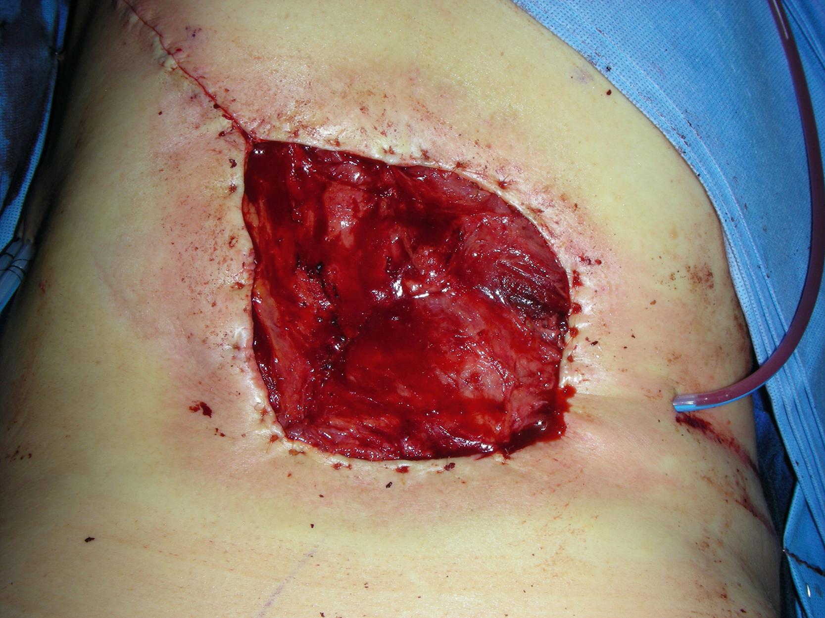 Middle Back Reconstruction - Clinical Tree
