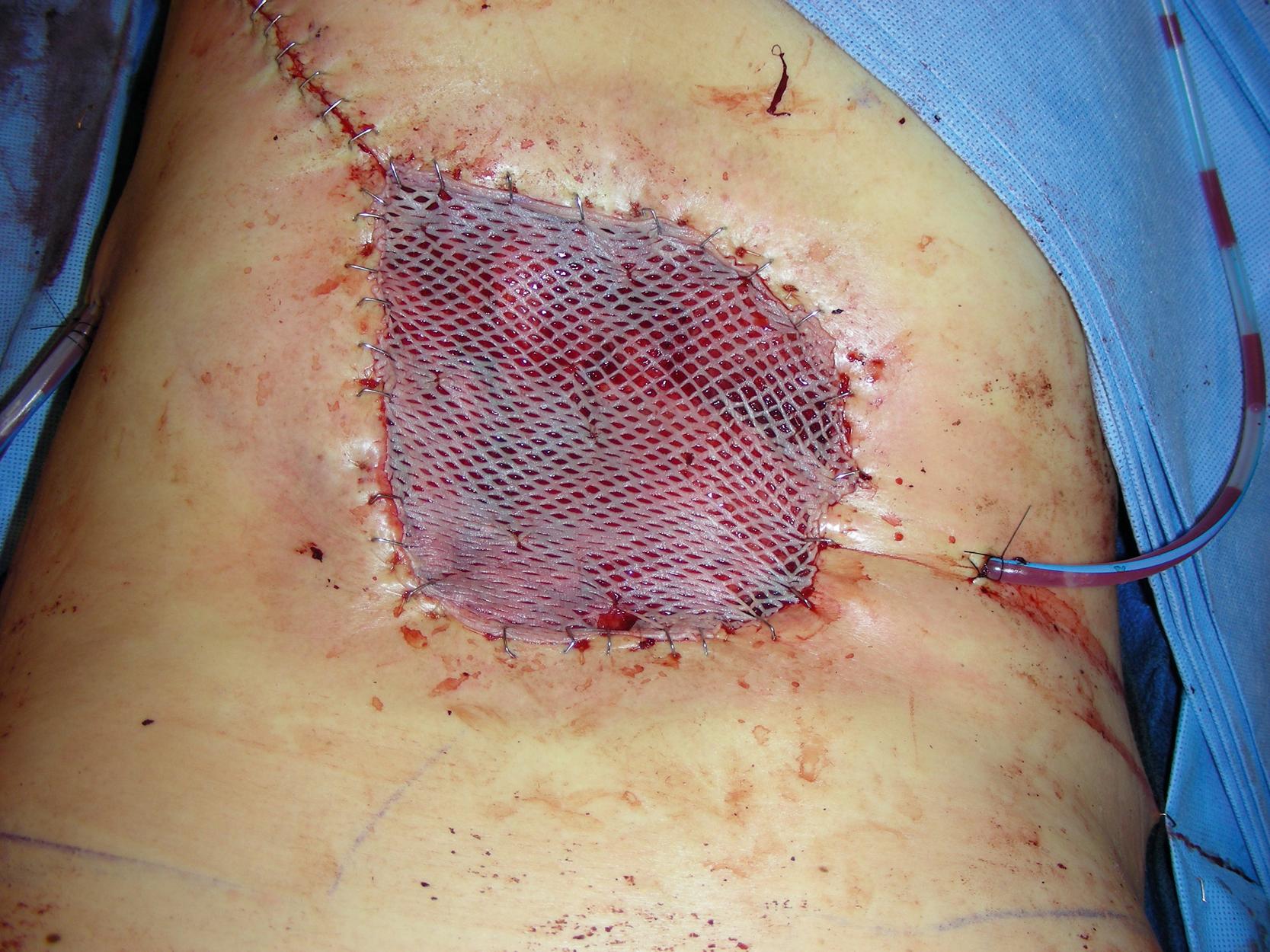 Middle Back Reconstruction - Clinical Tree