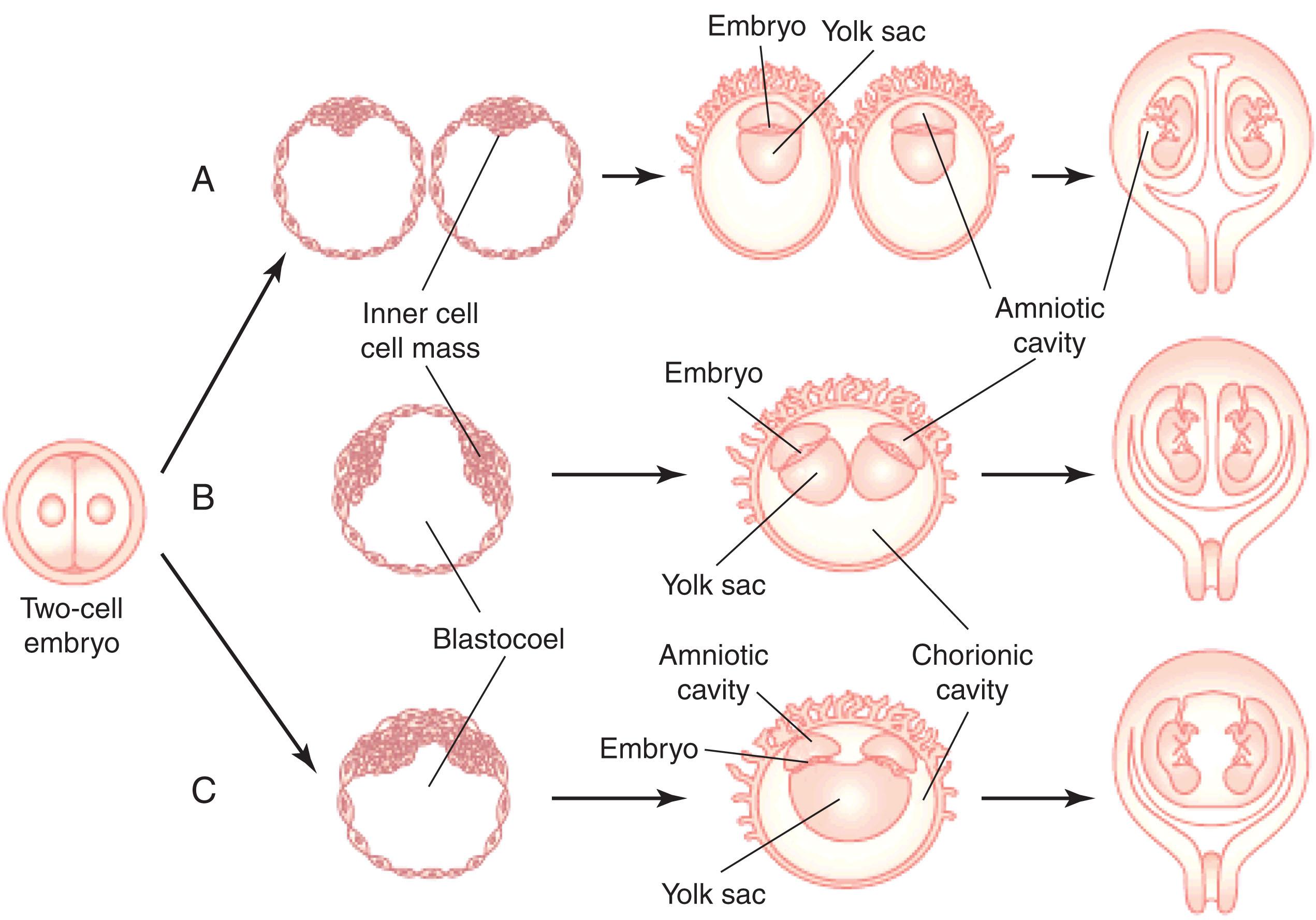 Multiple Gestations and Assisted Reproductive Technology - Clinical Tree