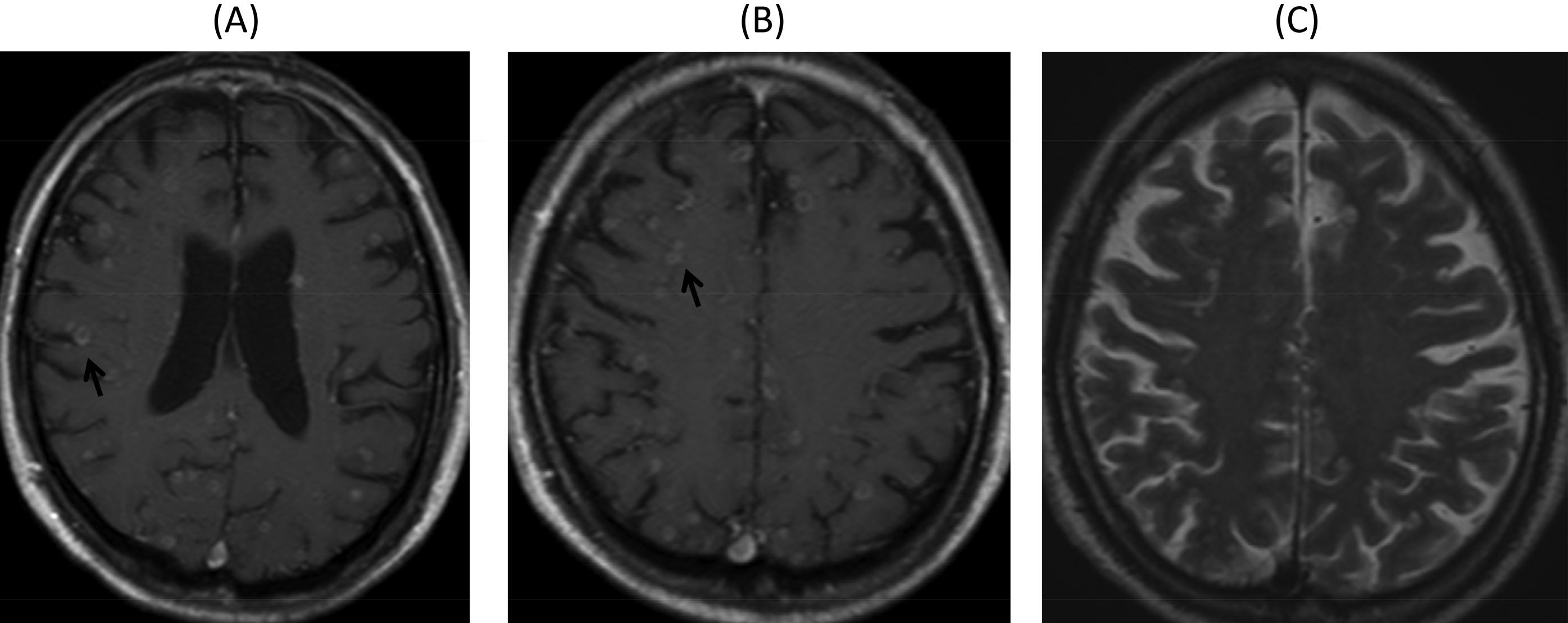 Multiple Small Brain Metastases with Limited Focal Brain Edema from Non ...