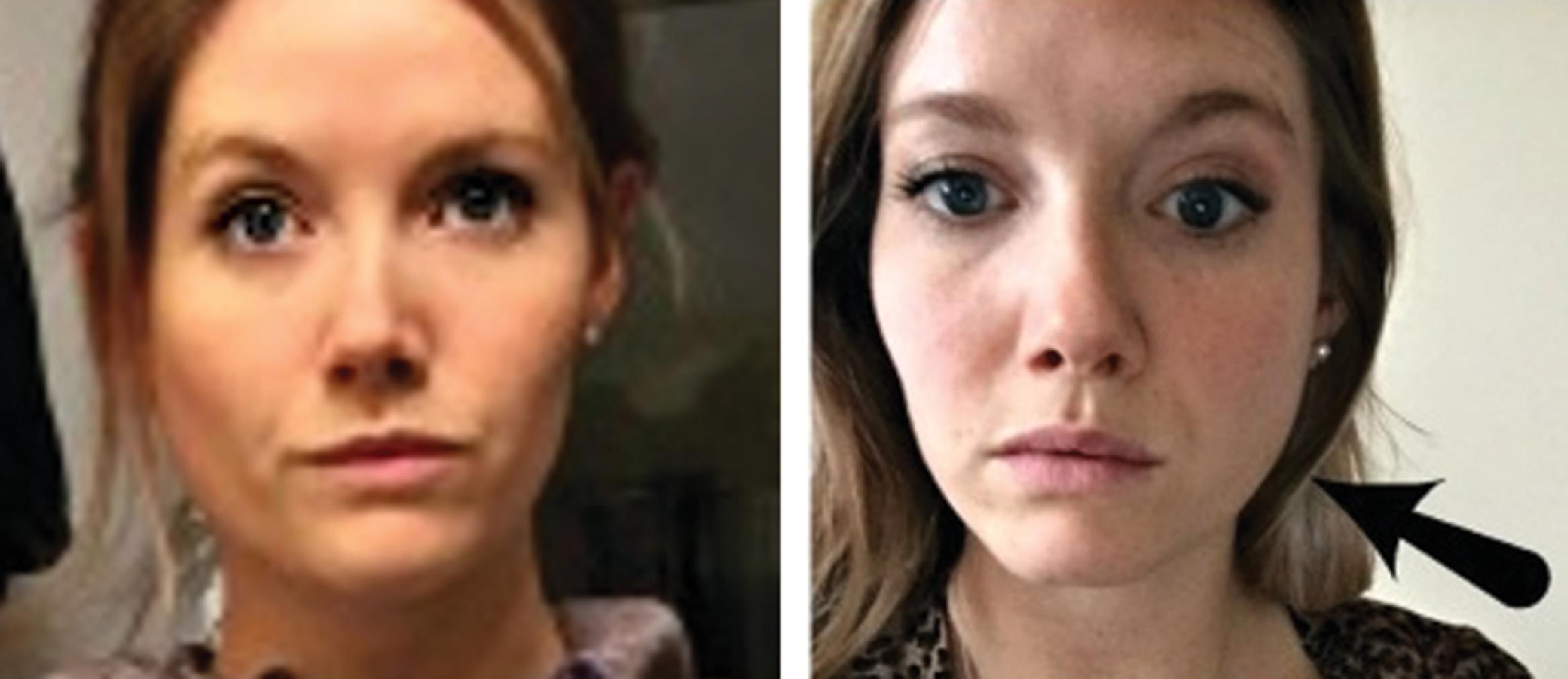 Mumps Vaccines - Clinical Tree