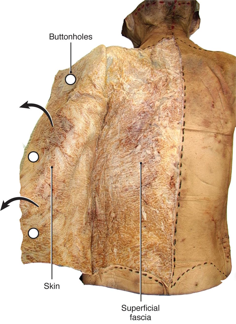 Muscles of the Back and Scapula - Clinical Tree