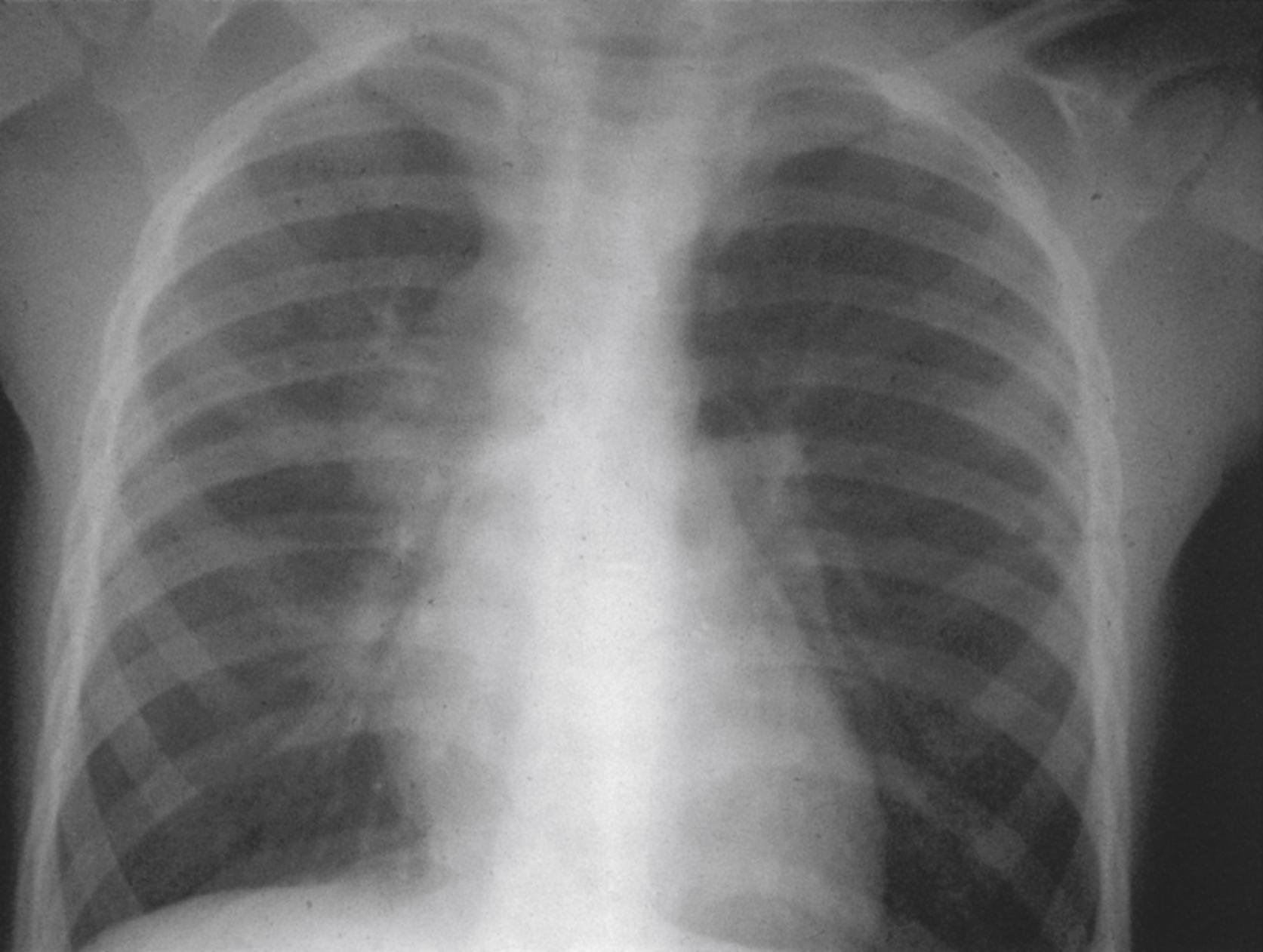 Mycobacterium tuberculosis - Clinical Tree