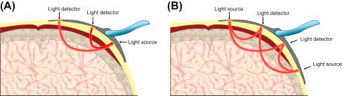 Near-Infrared Spectroscopy - Clinical Tree