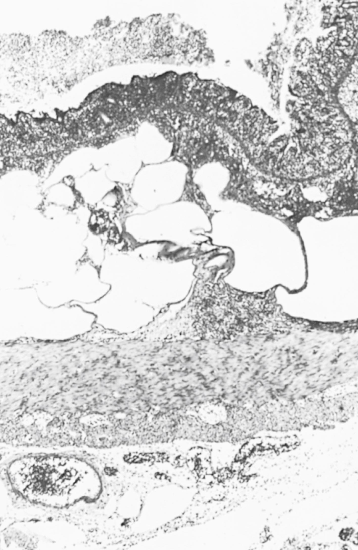 Neonatal Necrotizing Enterocolitis - Clinical Tree