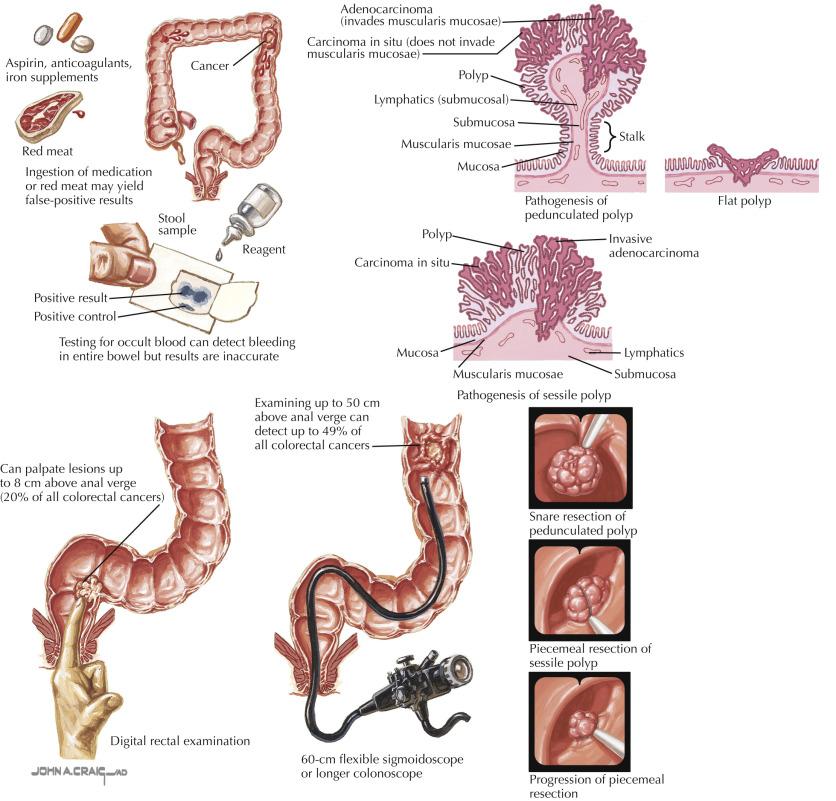 Neoplasms of the Large Bowel: Colon Polyps and Colon Cancer - Clinical Tree