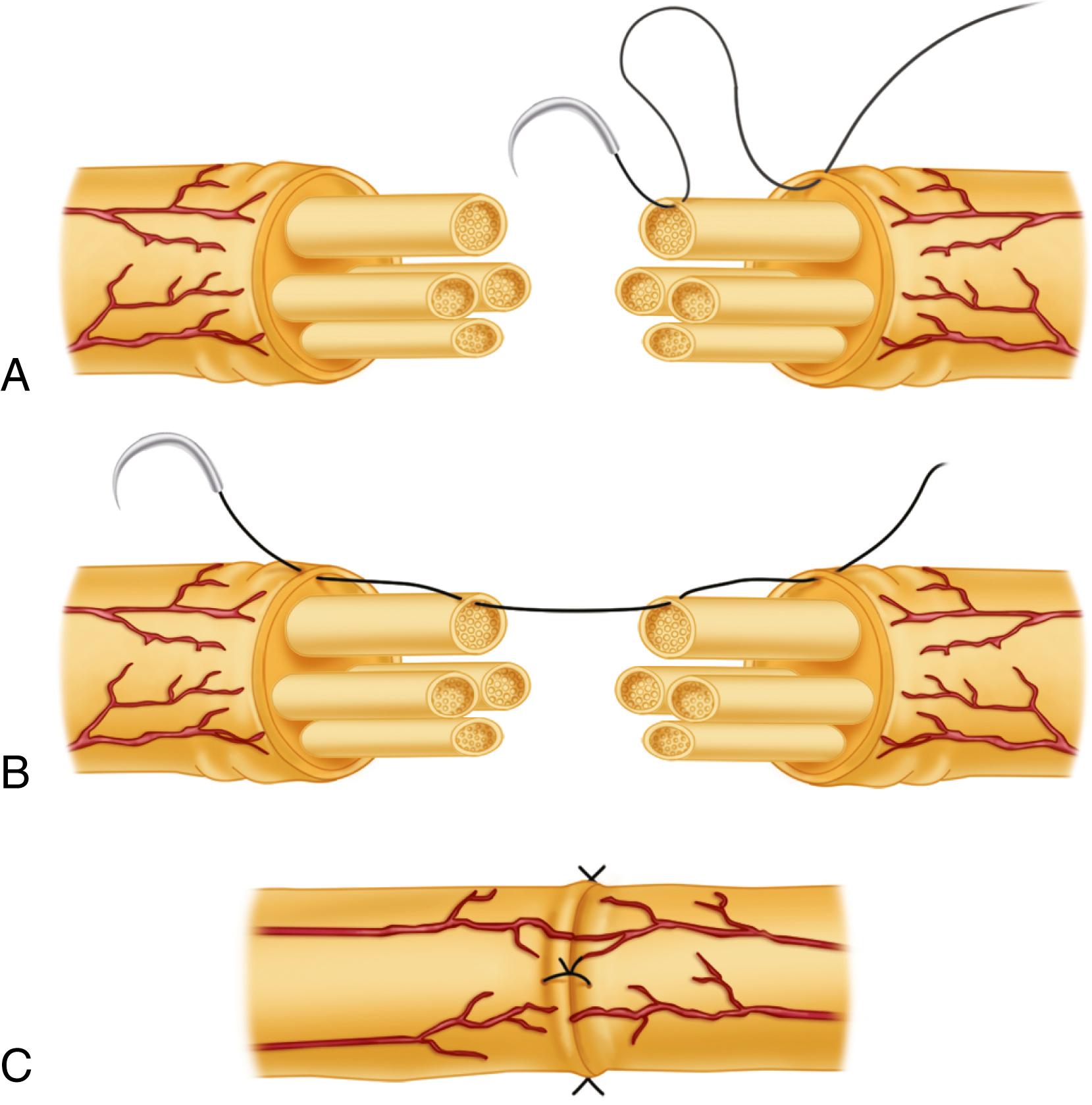 Nerve Injuries at the Level of the Hand and Wrist - Clinical Tree