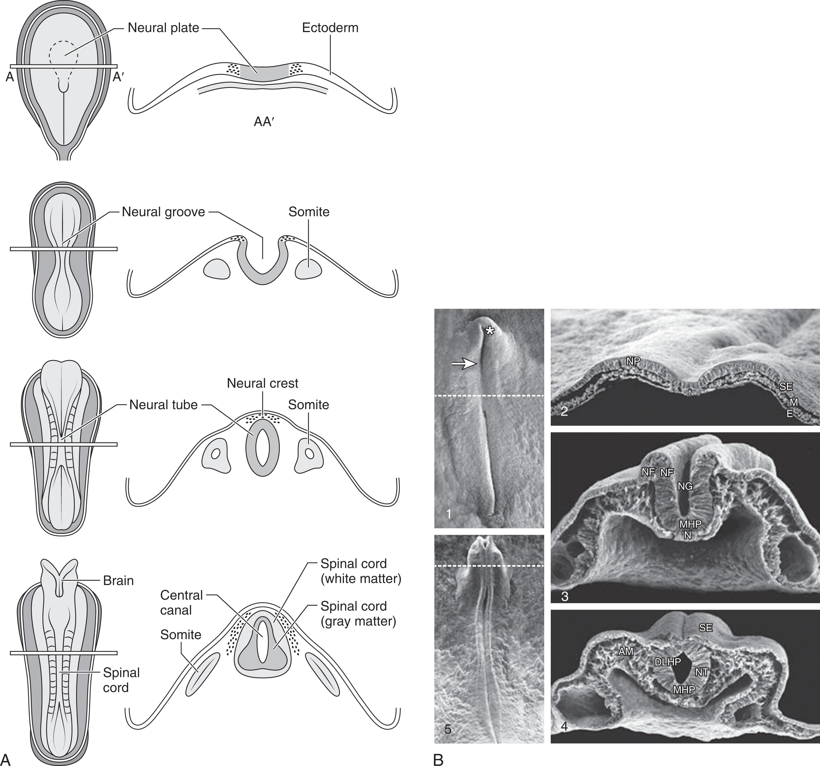 Neural Tube Development - Clinical Tree
