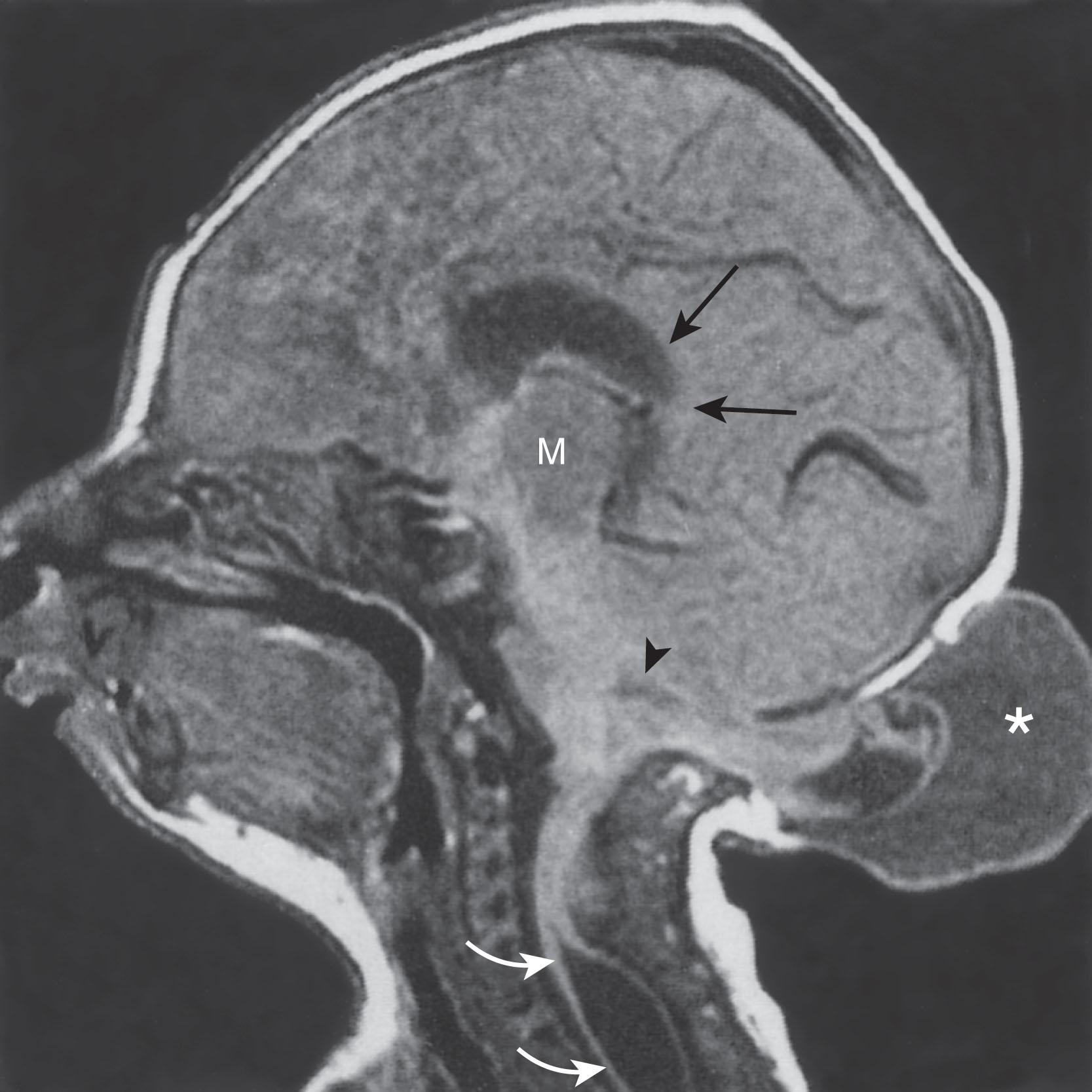 Neural Tube Development - Clinical Tree