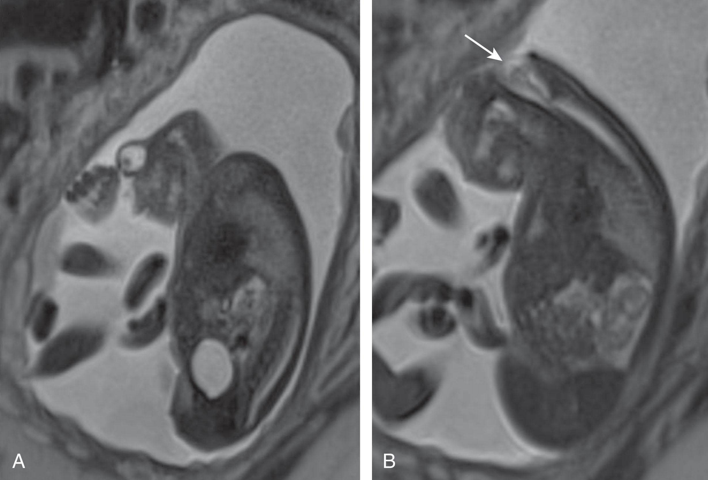 Neural Tube Development - Clinical Tree