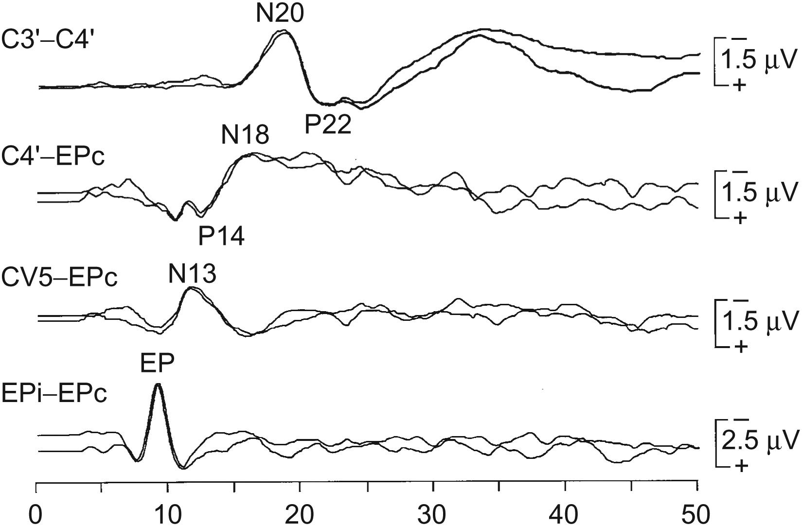 Neurologic Complications of Cardiac Arrest - Clinical Tree