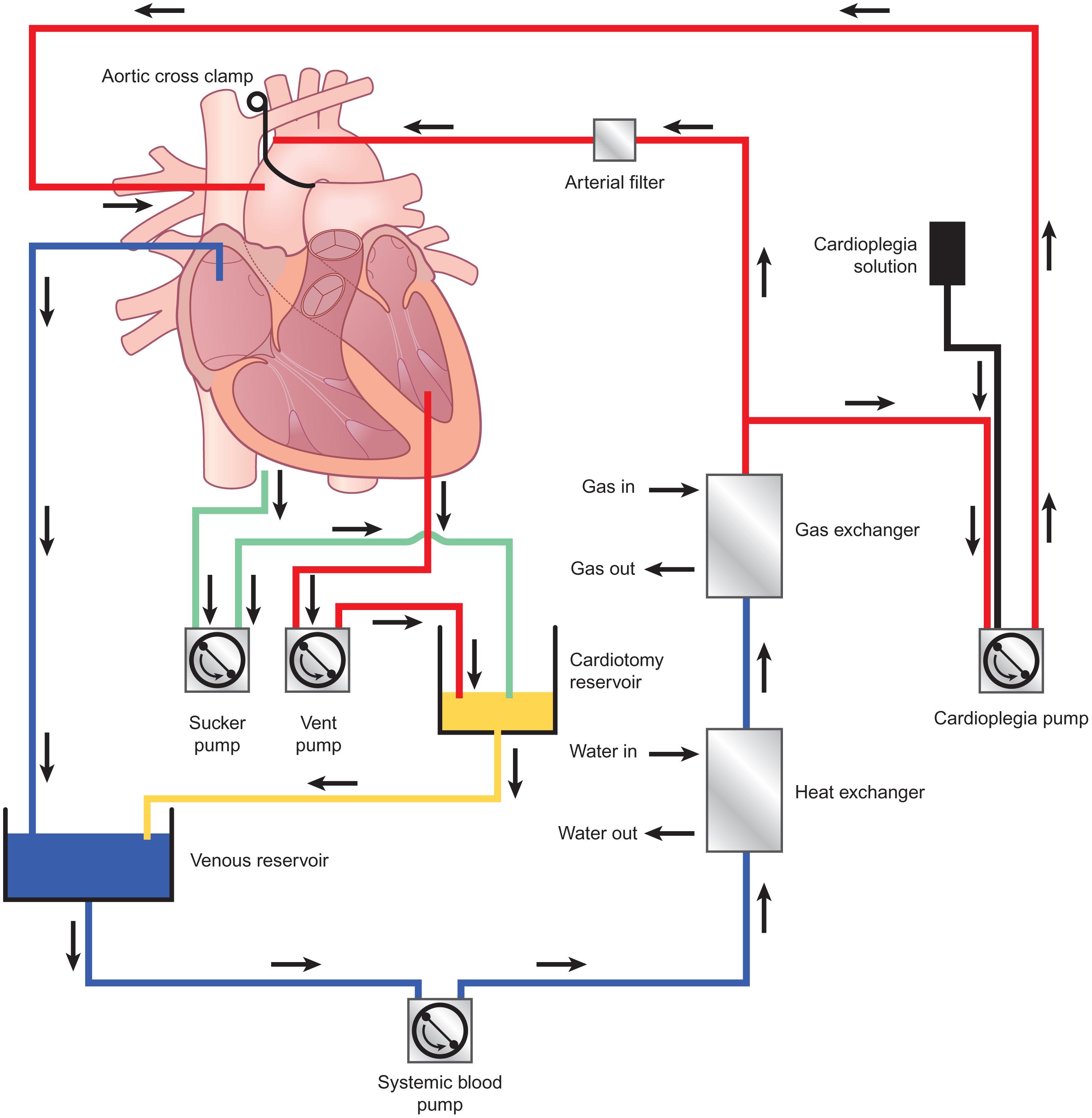 Neurologic Complications of Cardiac Surgery - Clinical Tree