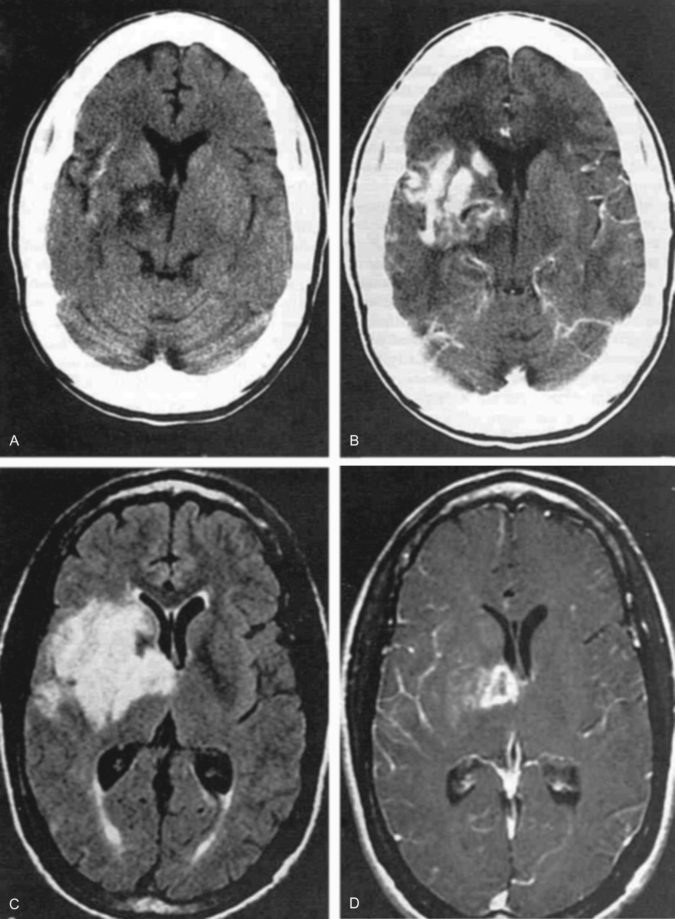 Neurologic Manifestations of Infective Endocarditis - Clinical Tree