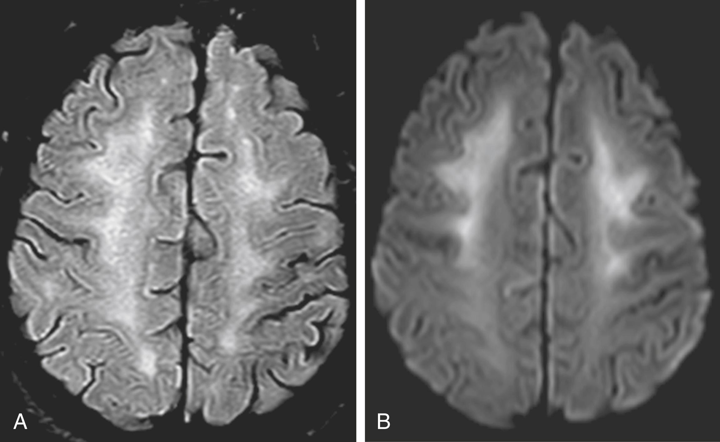 Neurological Manifestations of HIV and AIDS - Clinical Tree