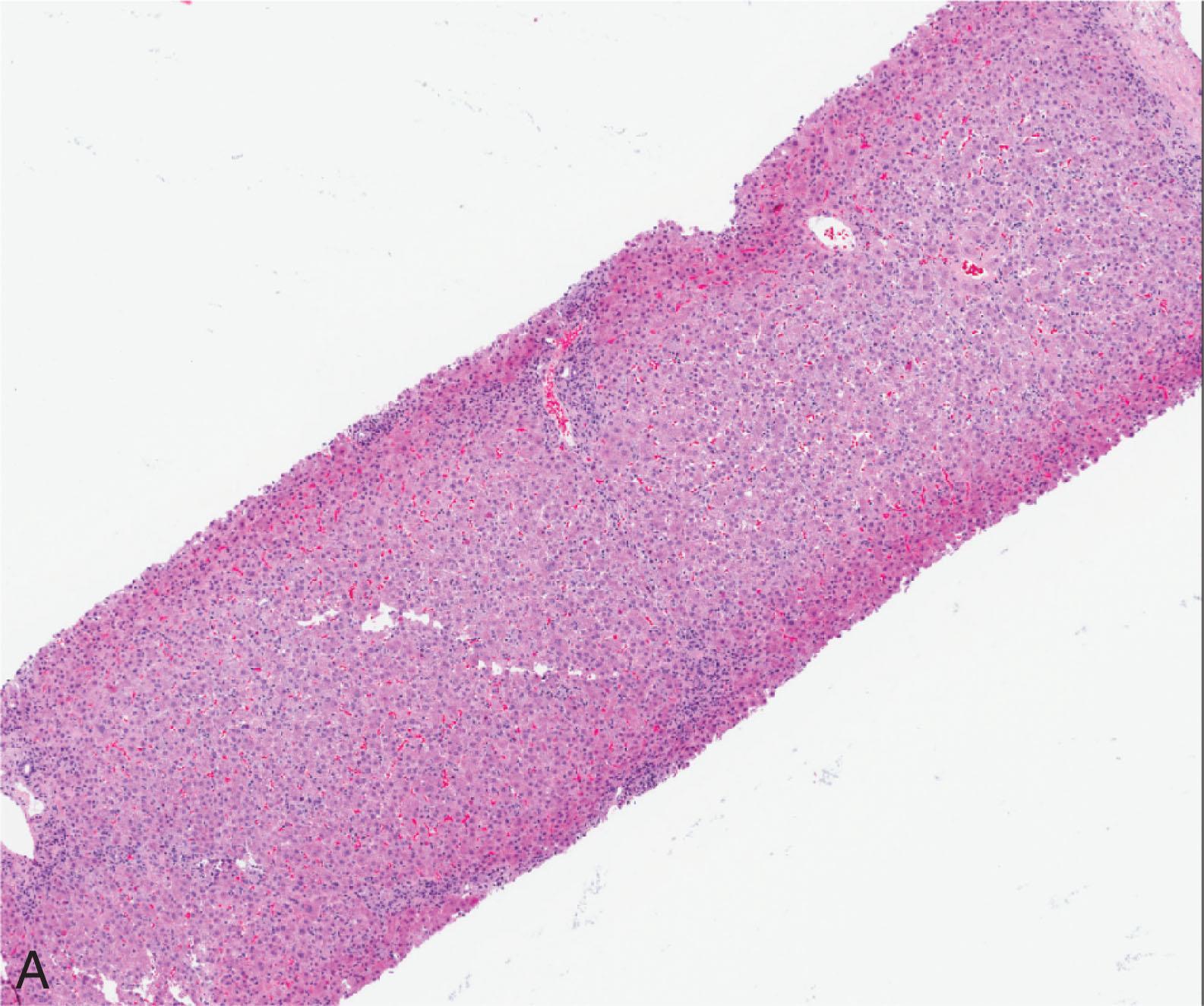 Non-Neoplastic Disorders of the Liver - Clinical Tree