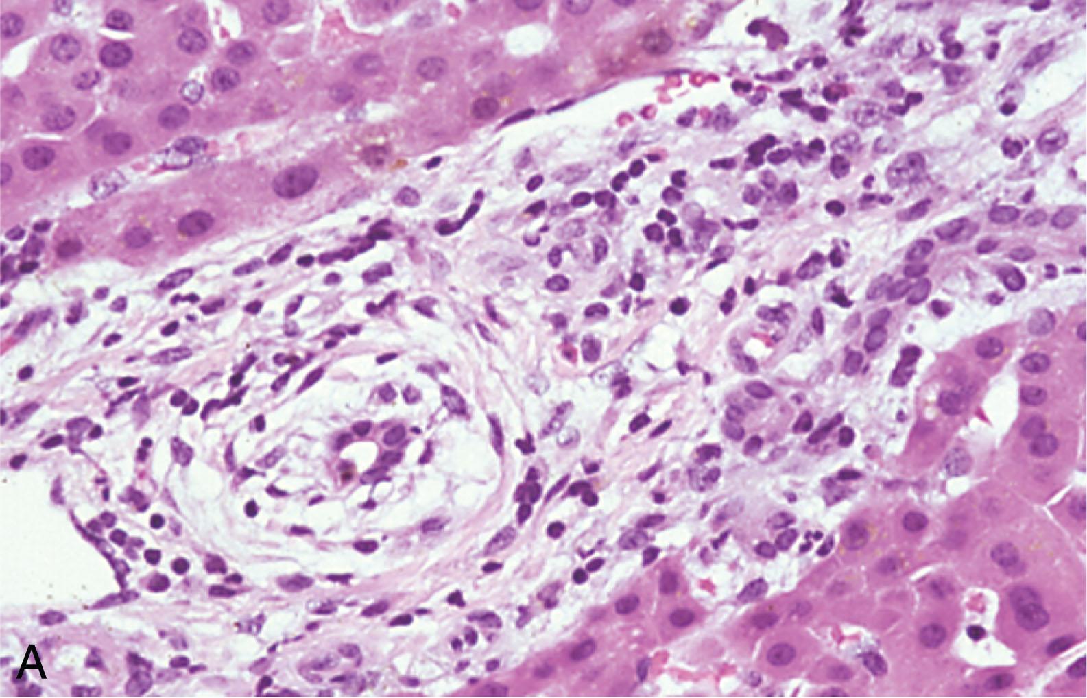 Non-Neoplastic Disorders of the Liver - Clinical Tree