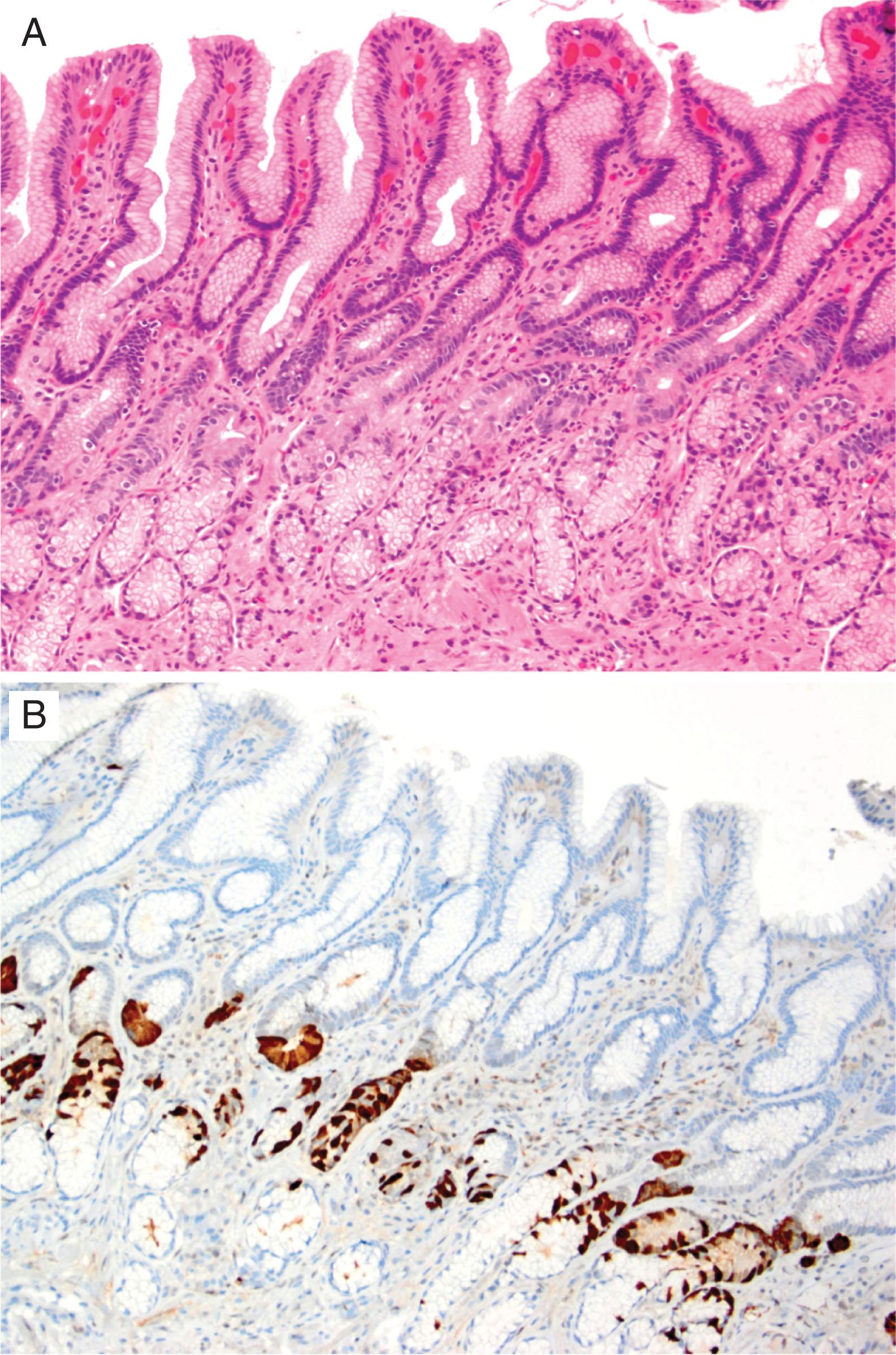 Non-Neoplastic Disorders of the Stomach - Clinical Tree