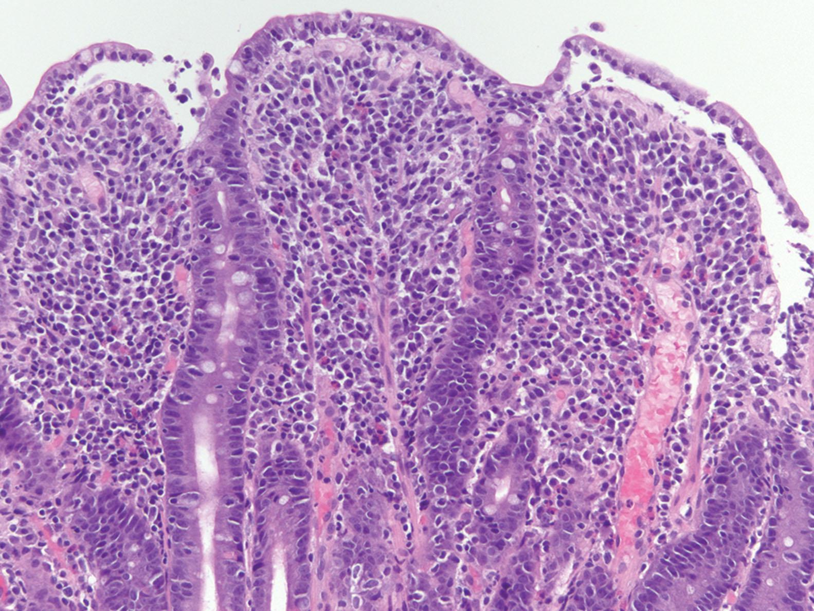 Non-Neoplastic and Inflammatory Disorders of the Small Bowel - Clinical ...