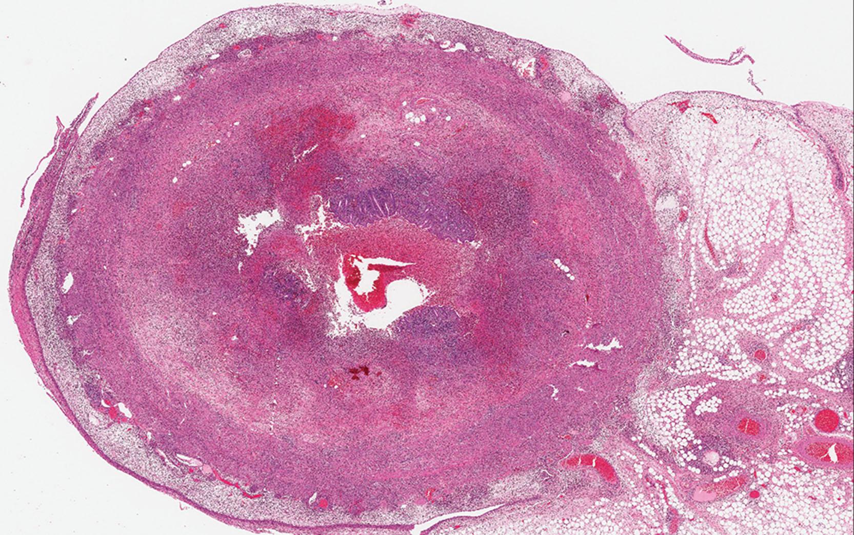 Non-Neoplastic and Neoplastic Disorders of the Appendix - Clinical Tree