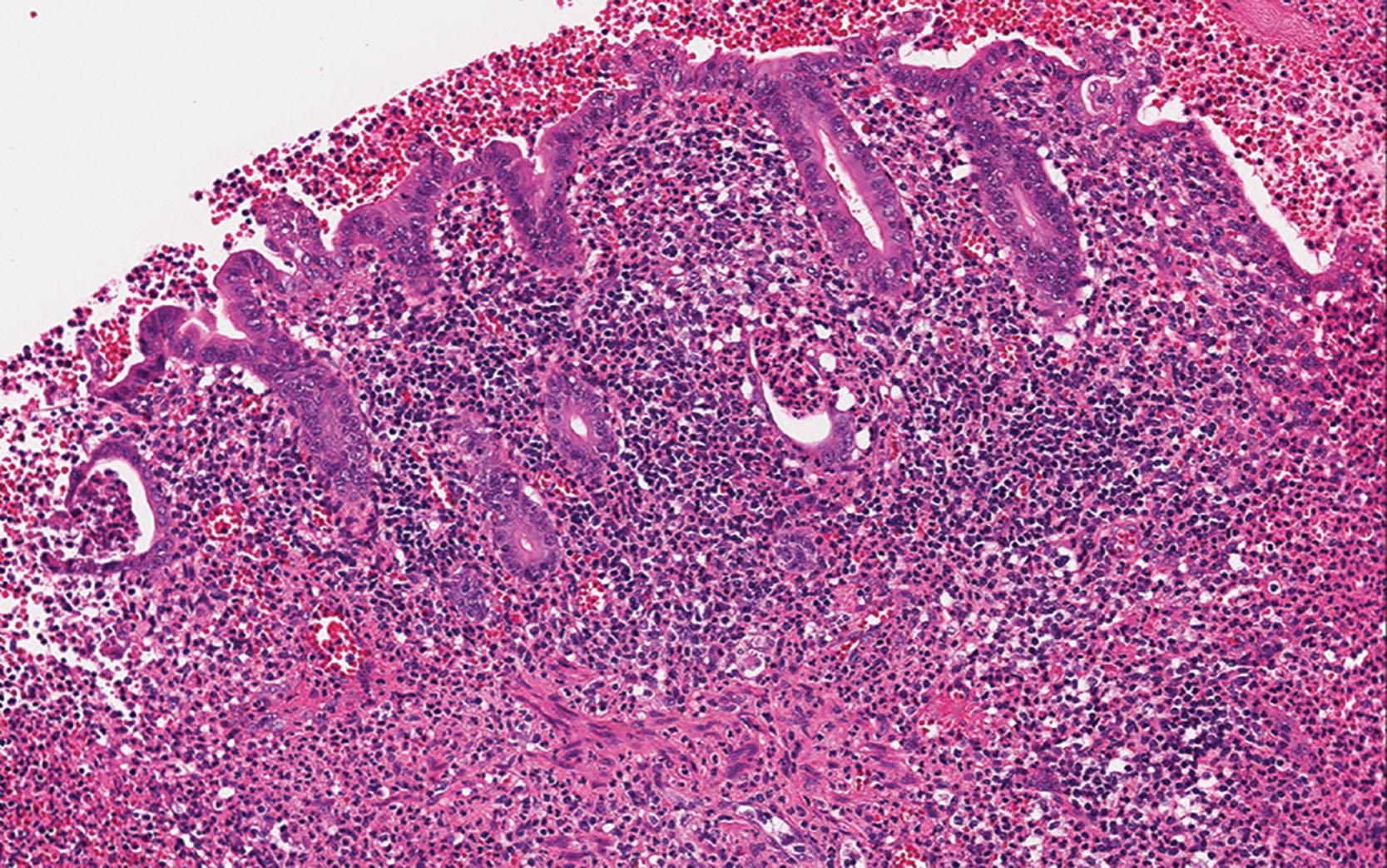Non-Neoplastic and Neoplastic Disorders of the Appendix - Clinical Tree