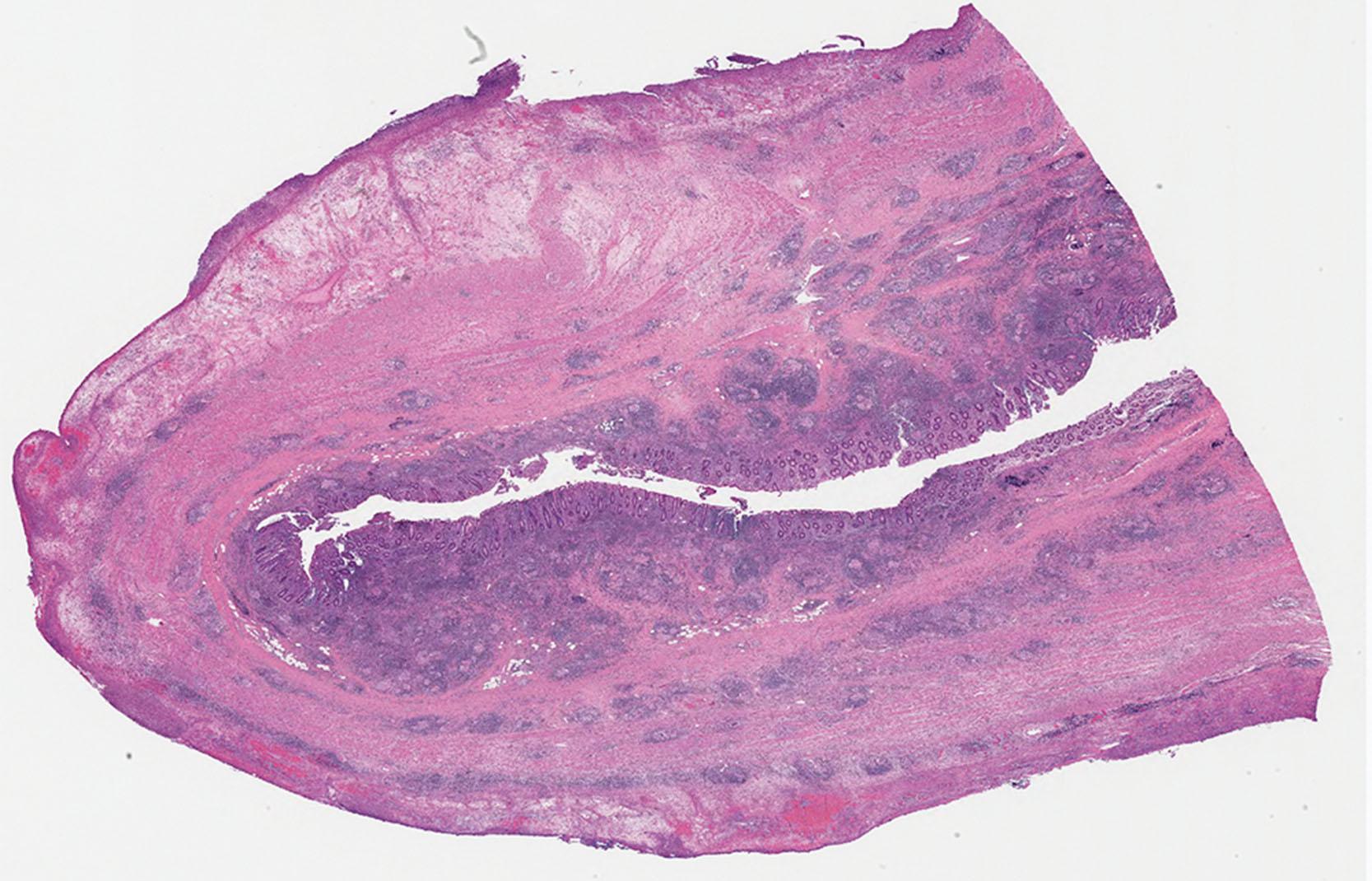 Non-Neoplastic and Neoplastic Disorders of the Appendix - Clinical Tree