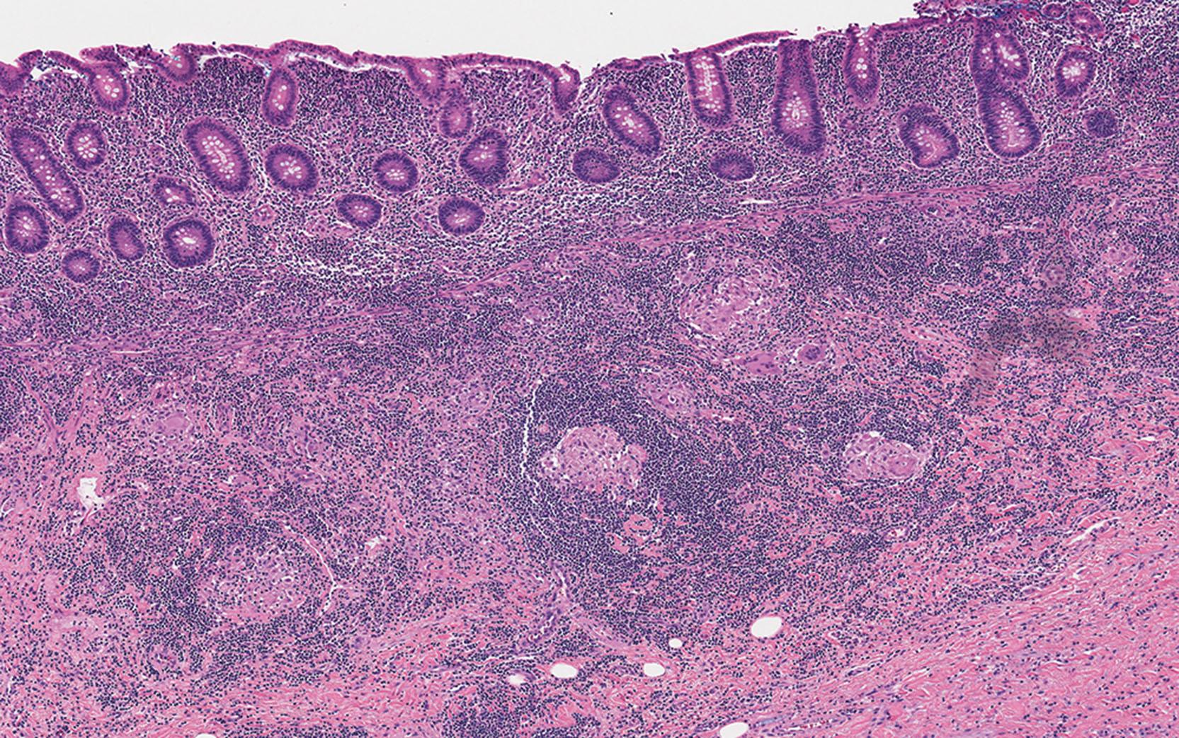 Non-Neoplastic and Neoplastic Disorders of the Appendix - Clinical Tree