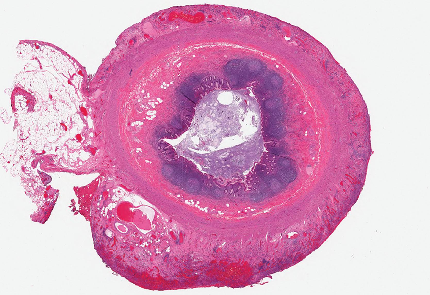 Non-Neoplastic and Neoplastic Disorders of the Appendix - Clinical Tree