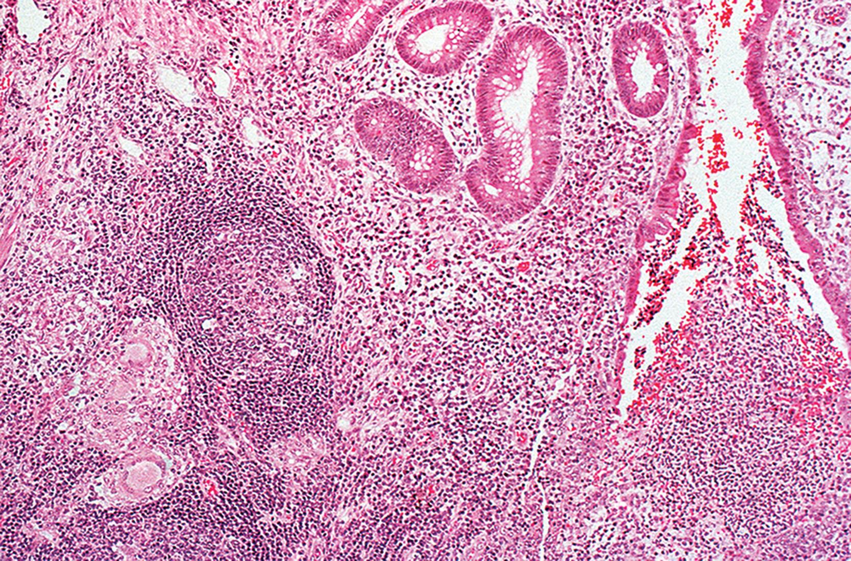 Non-Neoplastic and Neoplastic Disorders of the Appendix - Clinical Tree