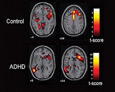 Noninvasive Brain–Computer Interfaces - Clinical Tree