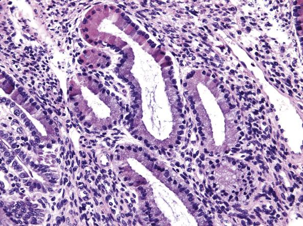 Nonneoplastic Lesions Of The Cervix Clinical Tree