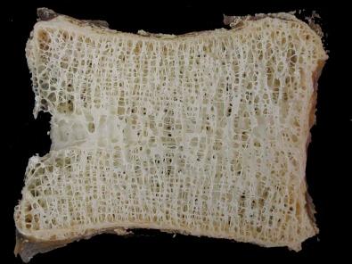Normal Bone Anatomy - Clinical Tree