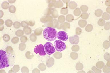 Normal Bone Marrow - Clinical Tree