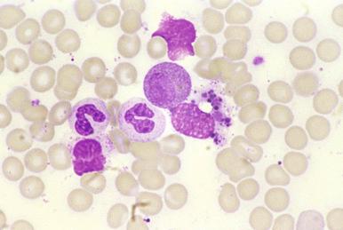 Normal Bone Marrow - Clinical Tree