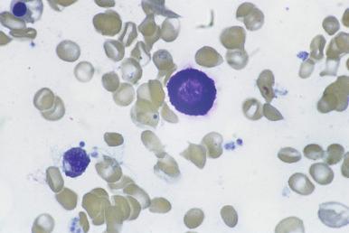 Normal Bone Marrow - Clinical Tree