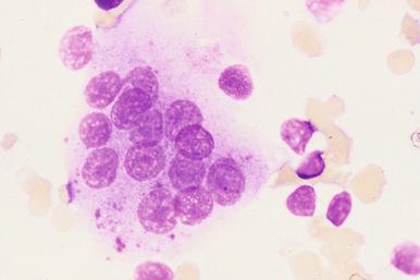 Normal Bone Marrow - Clinical Tree