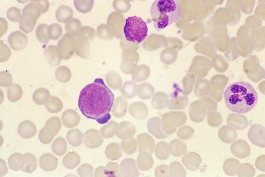 Normal Bone Marrow - Clinical Tree