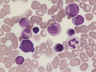 Normal Bone Marrow - Clinical Tree