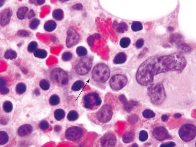 Normal Bone Marrow - Clinical Tree