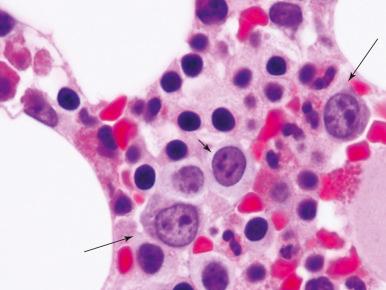 Normal Bone Marrow - Clinical Tree