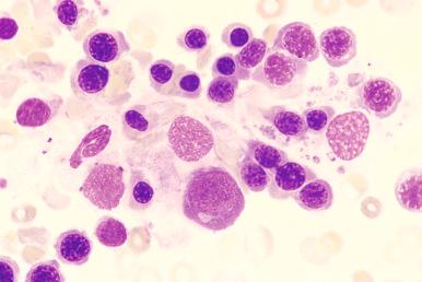 Normal Bone Marrow - Clinical Tree