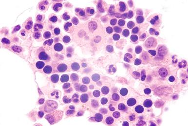 Normal Bone Marrow - Clinical Tree