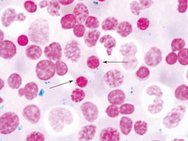 Normal Bone Marrow - Clinical Tree