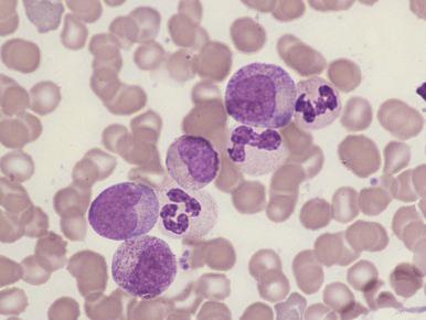 Normal Bone Marrow - Clinical Tree