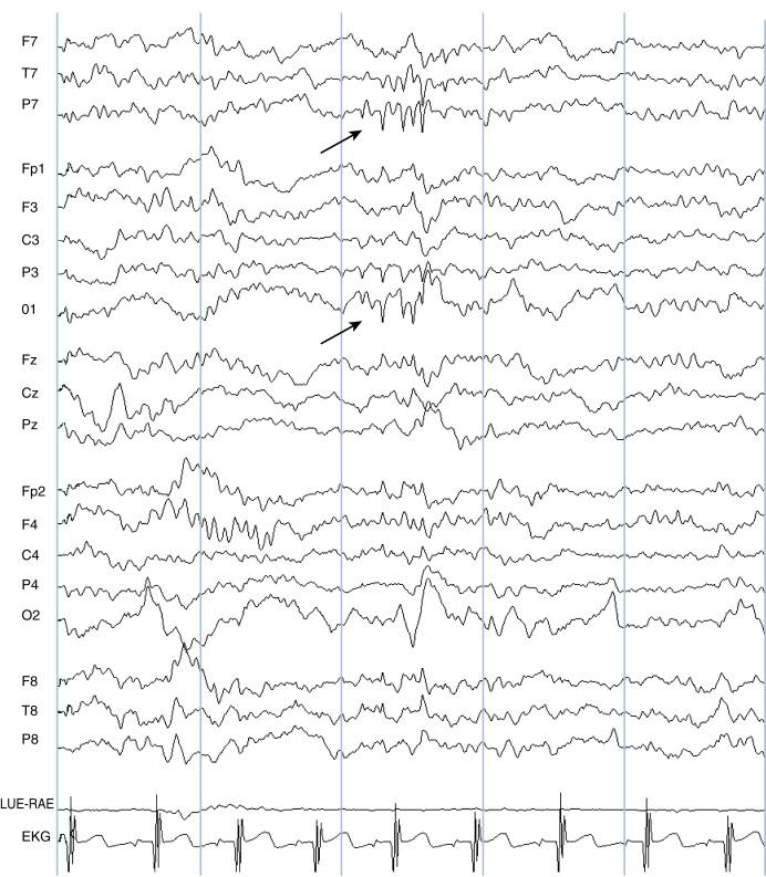 Normal Variants in the Electroencephalogram - Clinical Tree