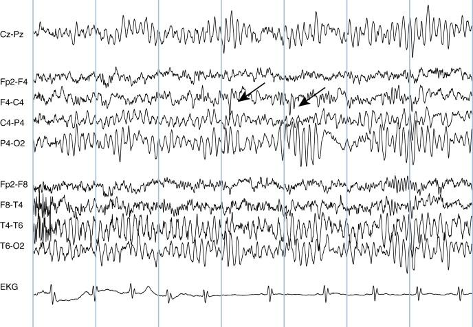 Normal Variants in the Electroencephalogram - Clinical Tree