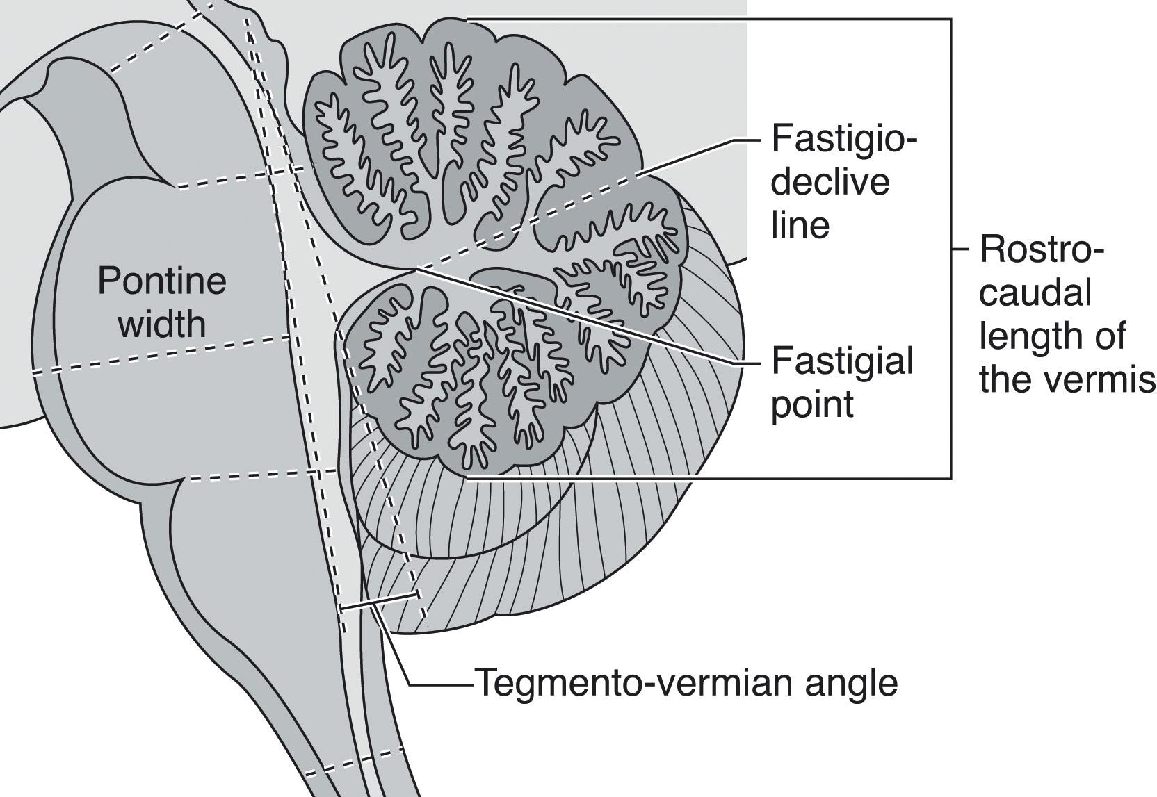 Normal and Abnormal Development of the Posterior Fossa Structures ...