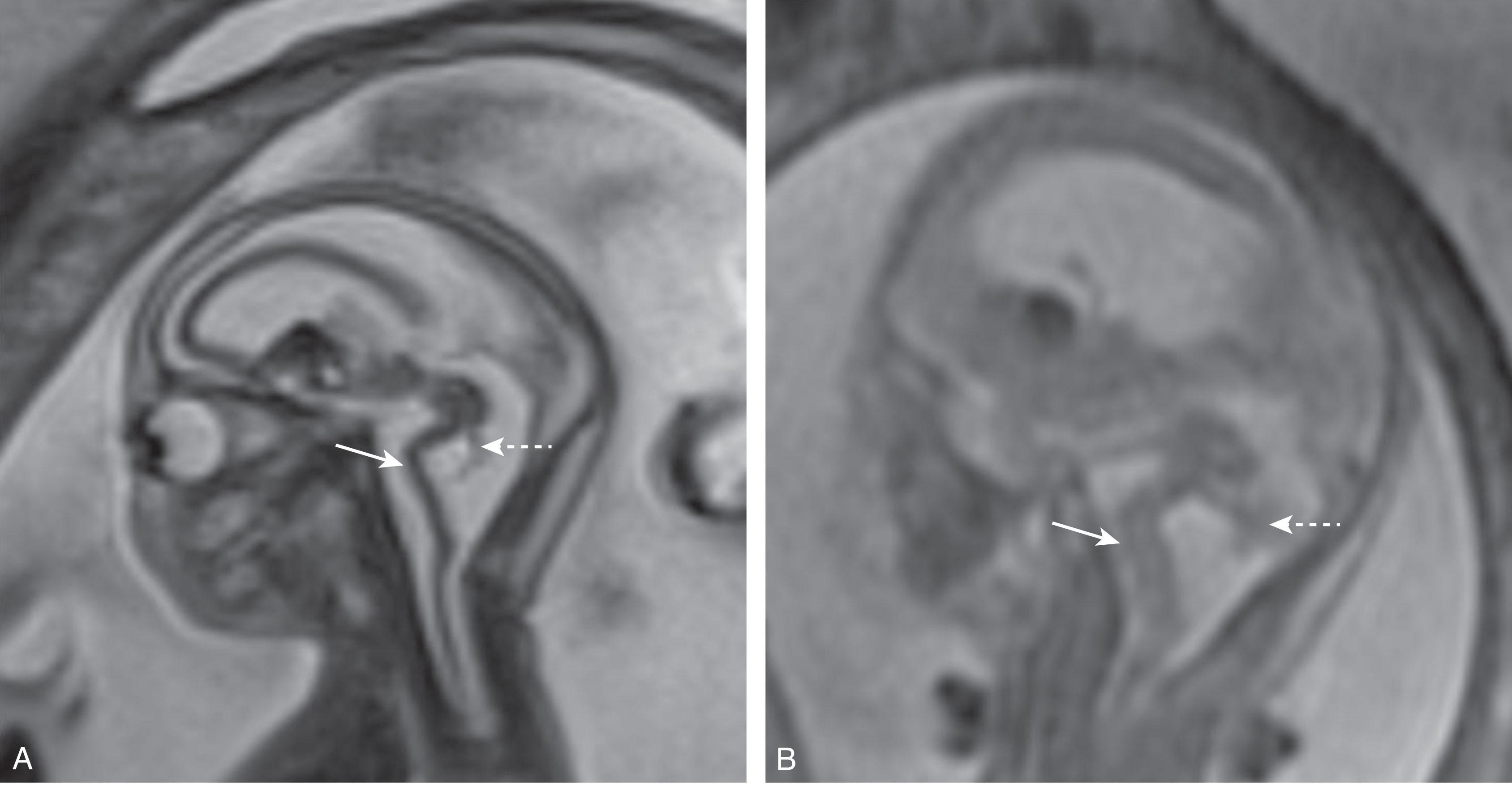 Normal and Abnormal Development of the Posterior Fossa Structures ...