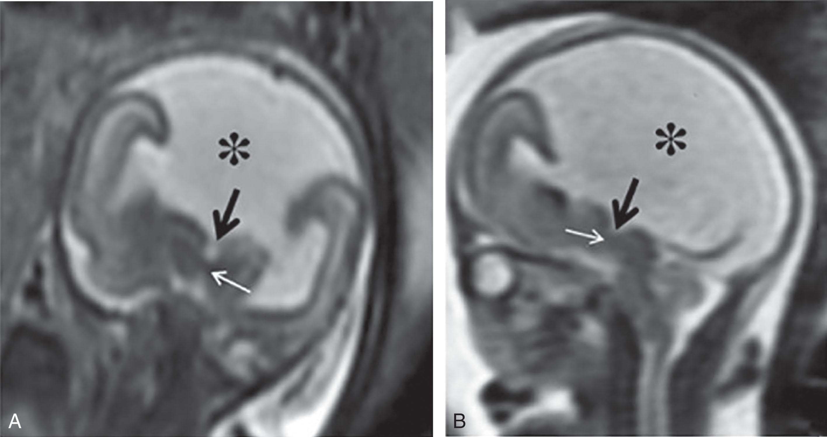 Normal and Abnormal Development of the Posterior Fossa Structures ...