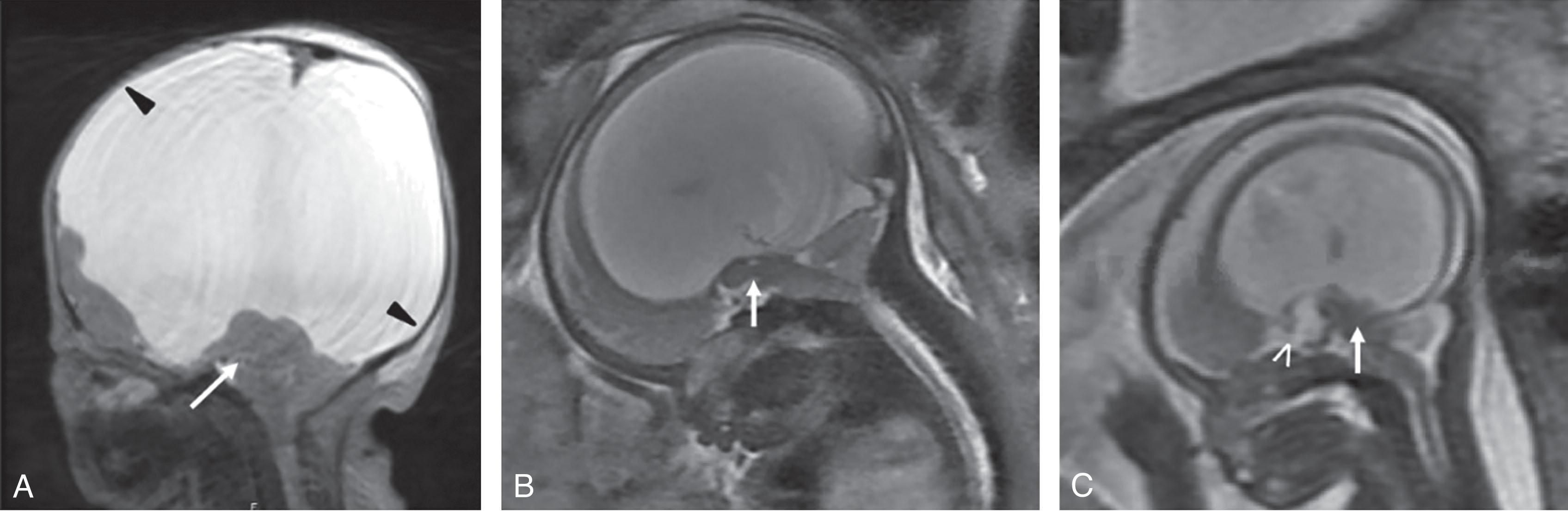 Normal and Abnormal Development of the Posterior Fossa Structures ...