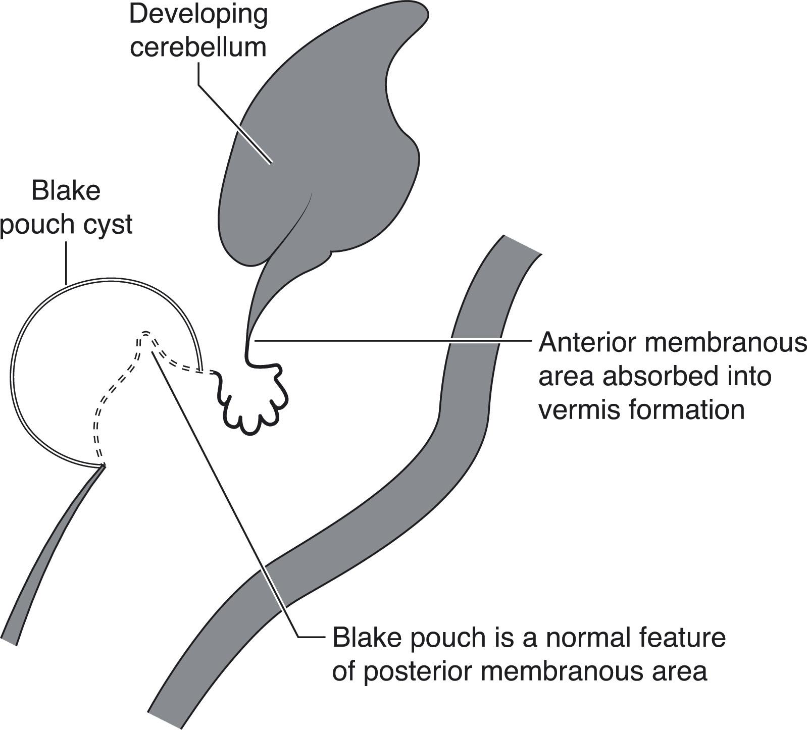 Normal and Abnormal Development of the Posterior Fossa Structures ...